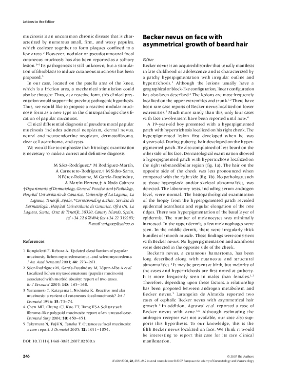 (PDF) Becker nevus on face with asymmetrical growth of beard hair