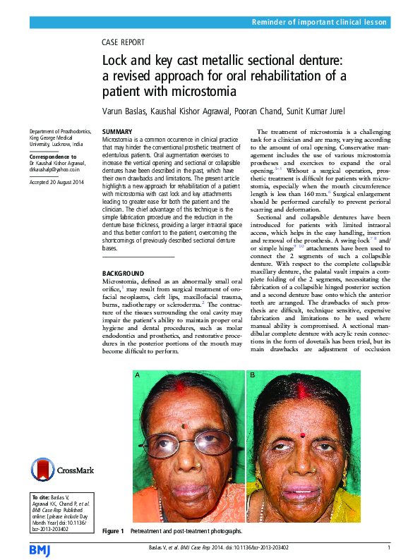 (PDF) Lock and key cast metallic sectional denture: a revised approach ...