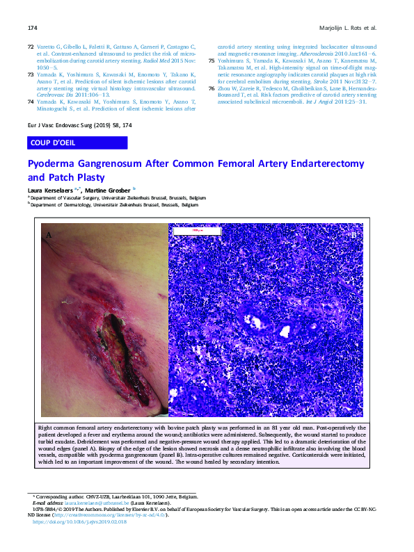 (PDF) Pyoderma Gangrenosum After Common Femoral Artery Endarterectomy ...