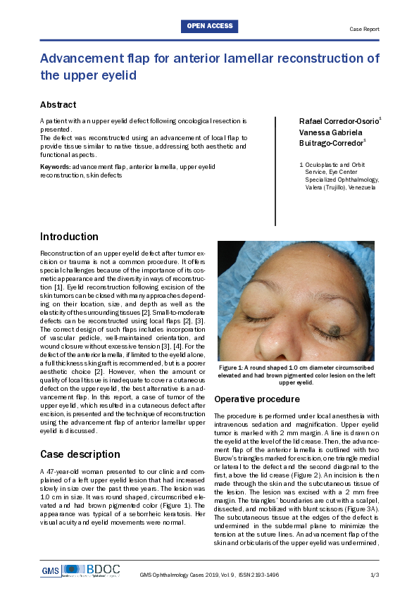 (PDF) Advancement Flap for Upper Eyelid Reconstruction