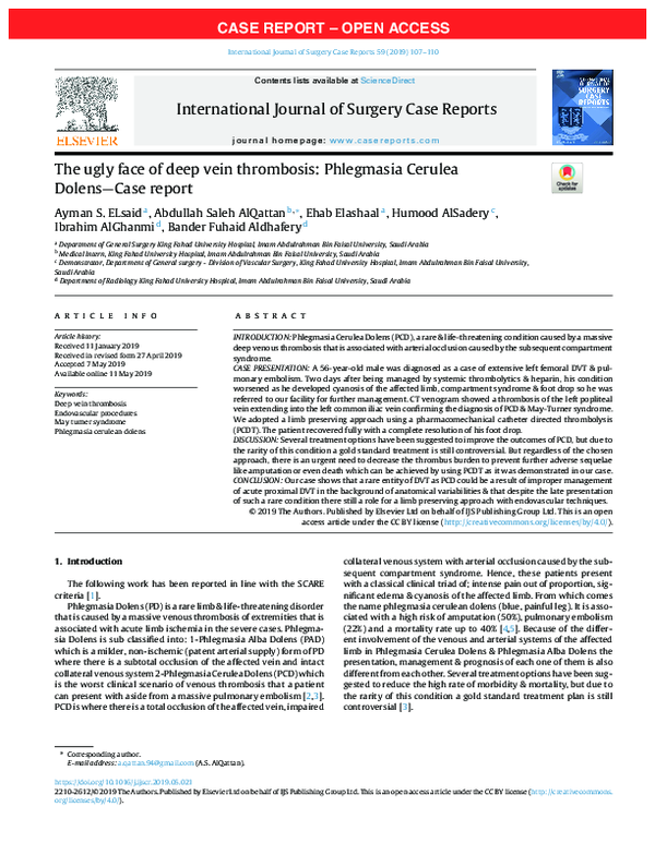 (PDF) The ugly face of deep vein thrombosis: Phlegmasia Cerulea Dolens ...