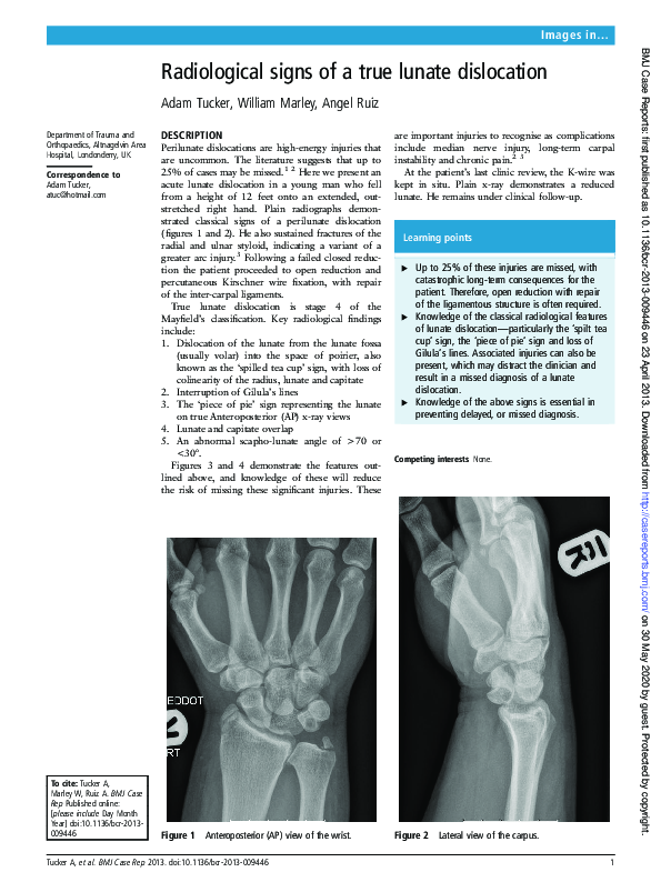 (PDF) Radiological signs of a true lunate dislocation