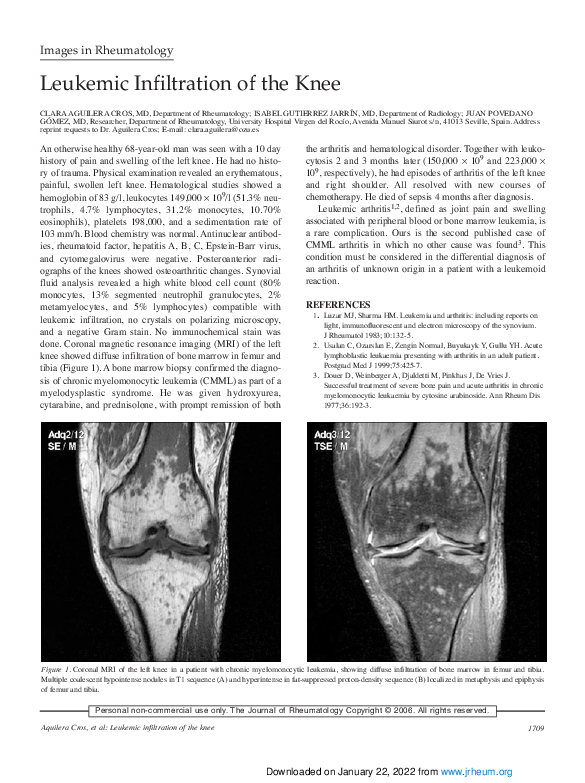 (PDF) Leukemic infiltration of the knee