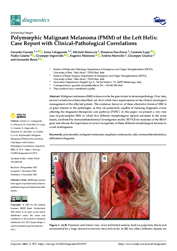 (PDF) Polymorphic Malignant Melanoma (PMM) of the Left Helix: Case ...
